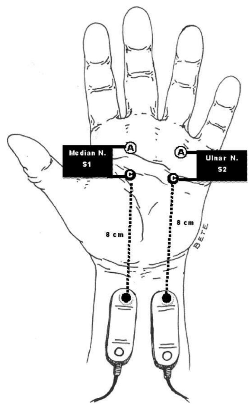 Figure 3 - from Electrodiagnostic evaluation of carpal
