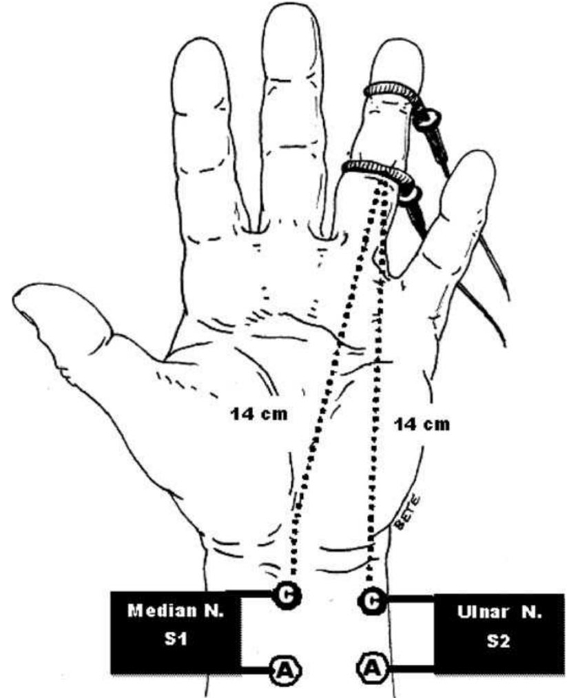 Median-ulnar sensory latency difference to the ring finger