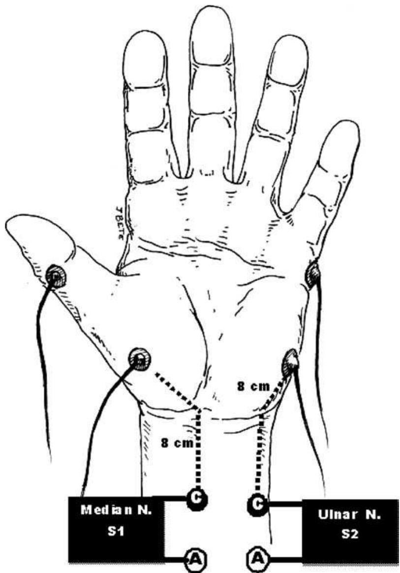Electrode placement for evoking the median-thenar (s1) and