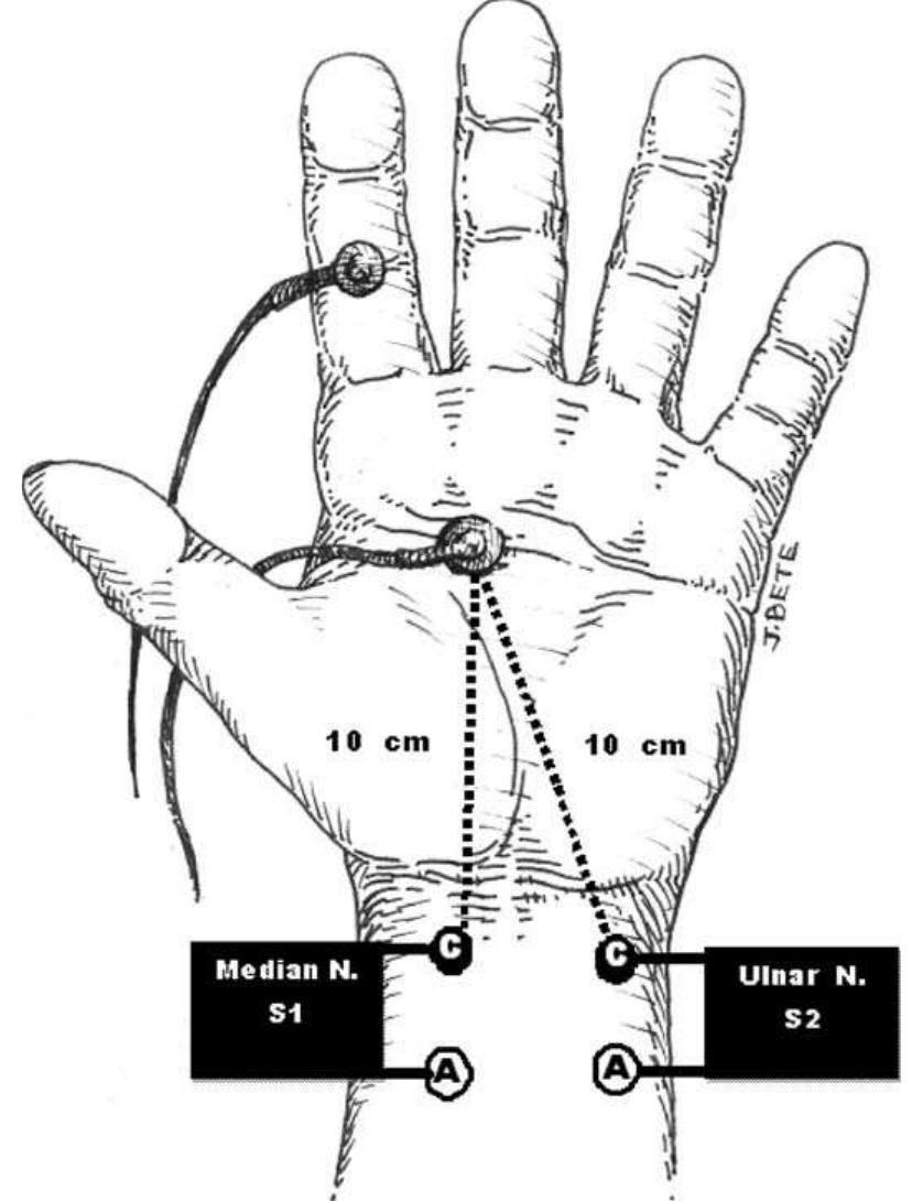 Median-ulnar motor latency difference to intrinsics.
