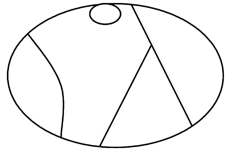 Schematic drawing of a multilocular cyst containing five