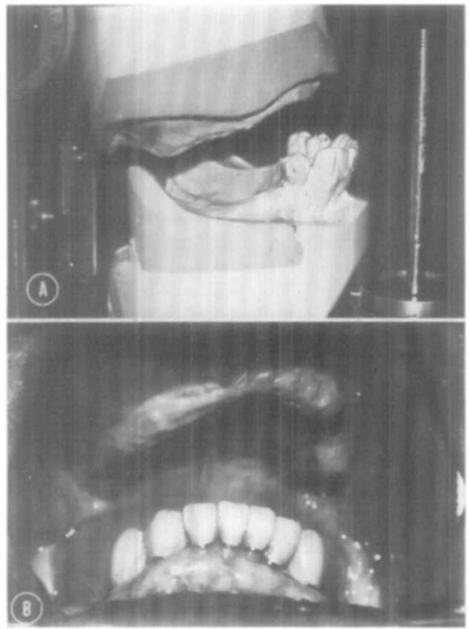 A and b, resorption of anterior maxillary ridge caused by