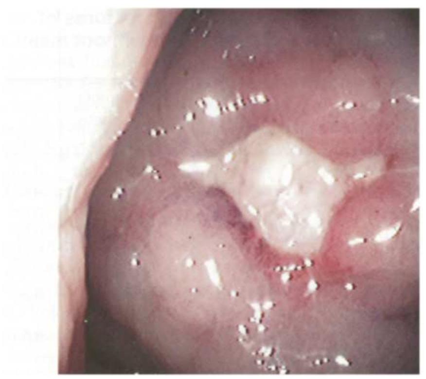 Endoscopic view of rectal ulcer with clean base.