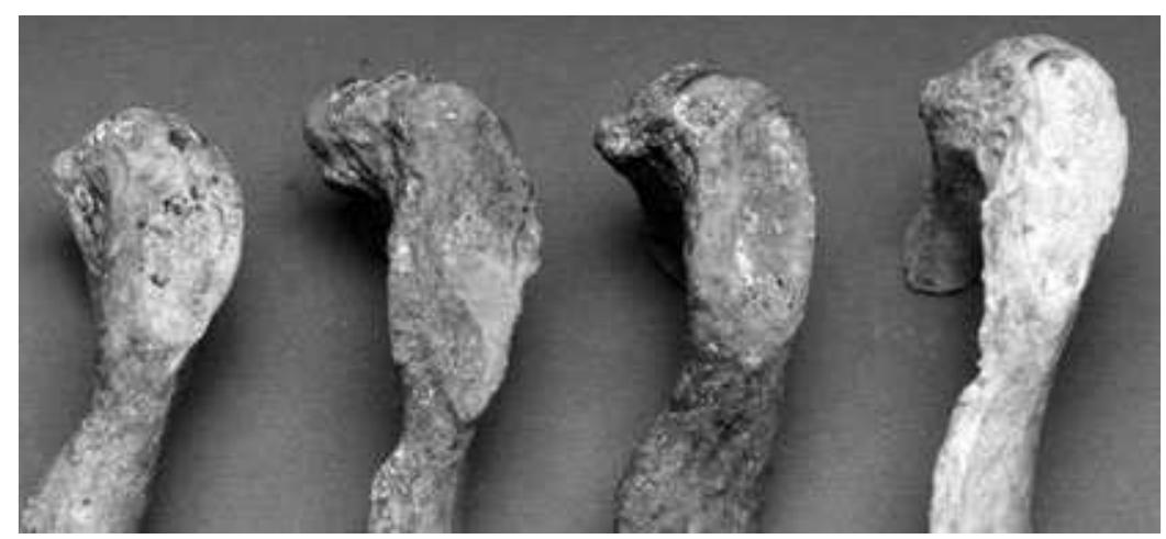 Al2—female pubic symphyseal morphology, ages 60-66 years.