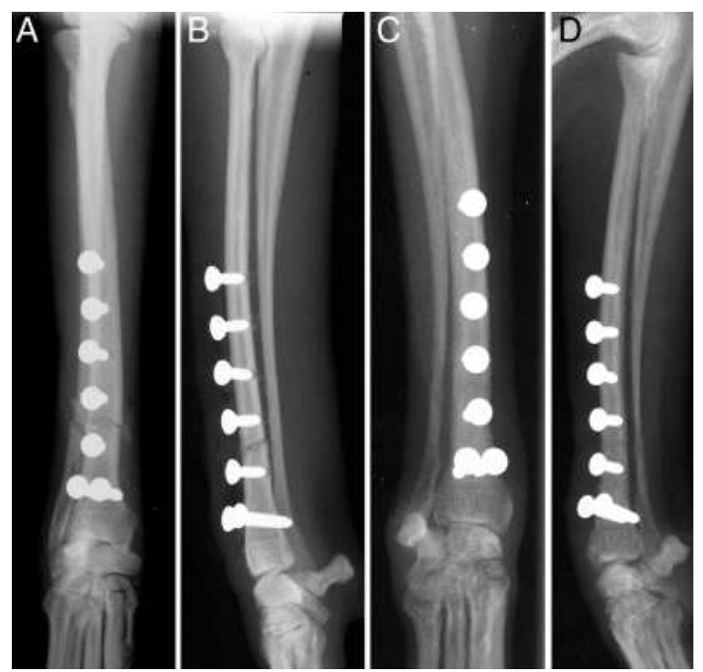 Radiographs of a distal radial/ulnar fracture repaired with