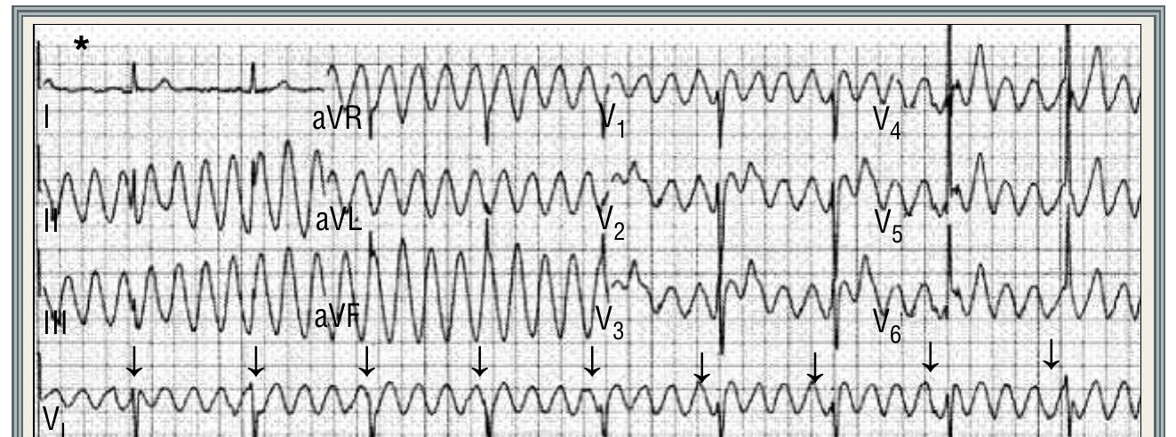 Artifact that mimics ventricular tachycardia. note the