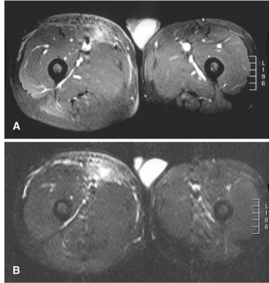 A, b pyomyositis of the right sartorius muscle due to mrsa