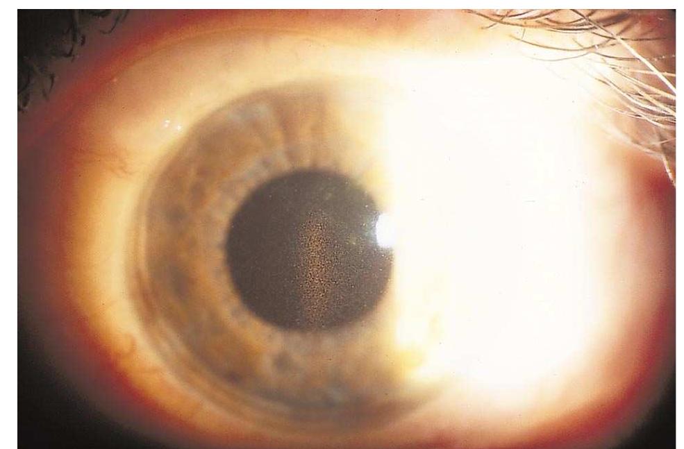 Corneal pigmentation similar to a krukenberg spindle. the