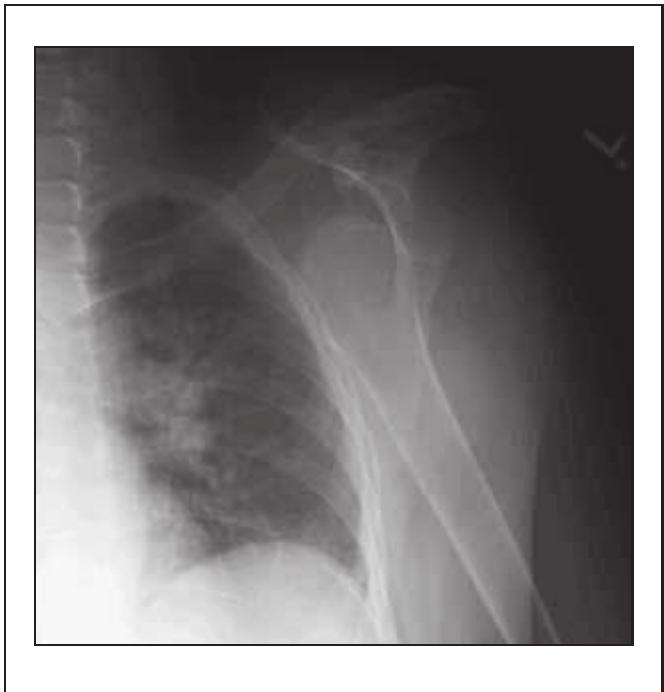 B: anterior shoulder dislocation, lateral view figure 1a: