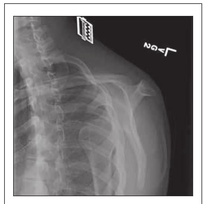 A: posterior shoulder dislocation, anterior-posterior view