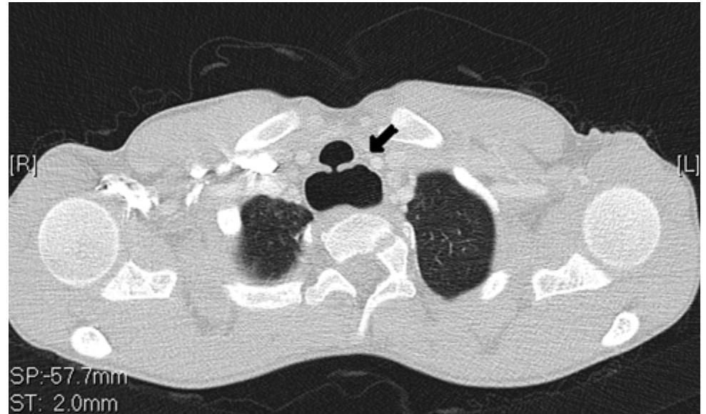 Hrct revealing dilated esophagus and h-type fistula between