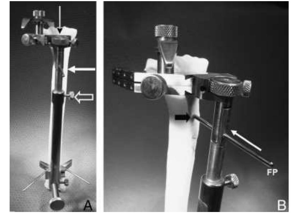 (a) the telescoping extramedullary tibial alignment guide
