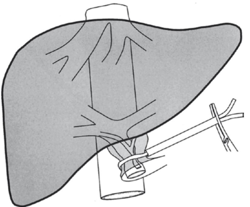 3. the pringle maneuver (reprinted with permission of