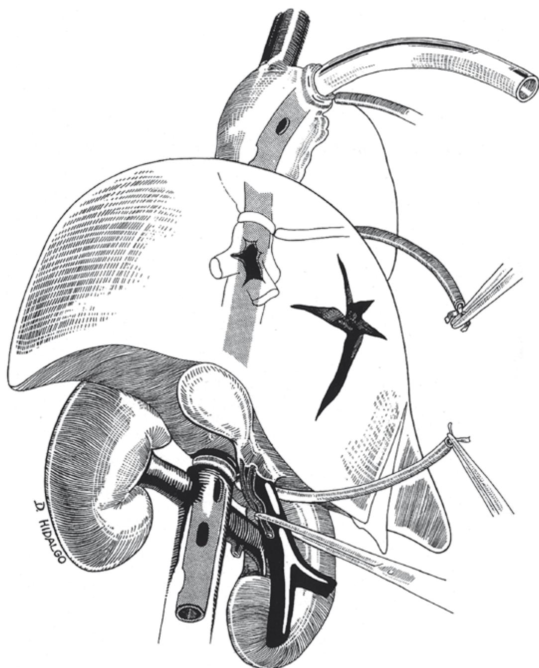 6 atriocaval shunt (reprinted with permission of the