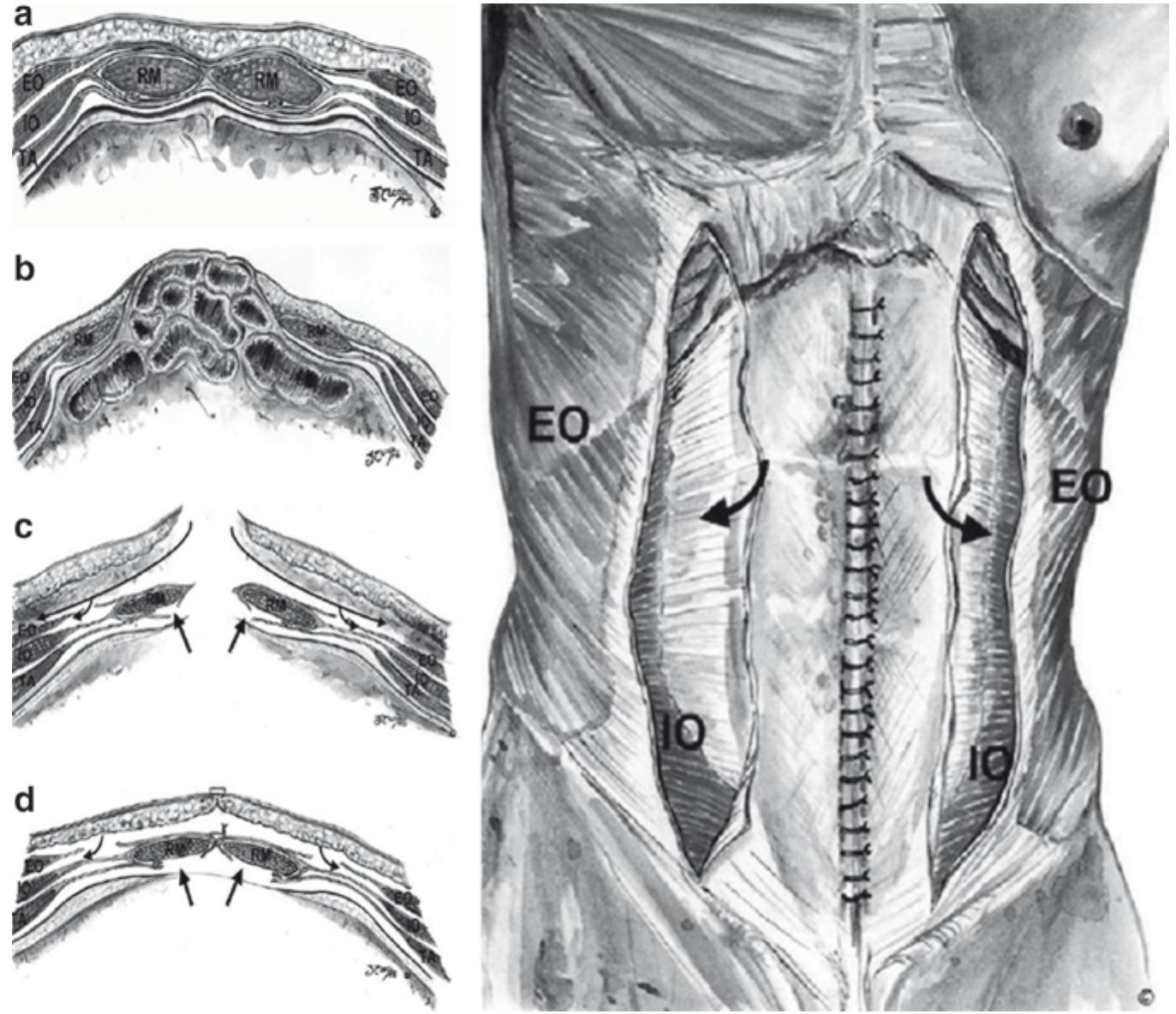 9 abcd. stages of component separation, abdominal wall