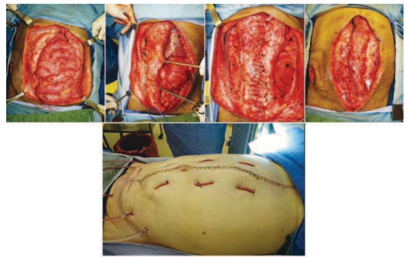 10 Stages Of Component Separation Abdominal Wall