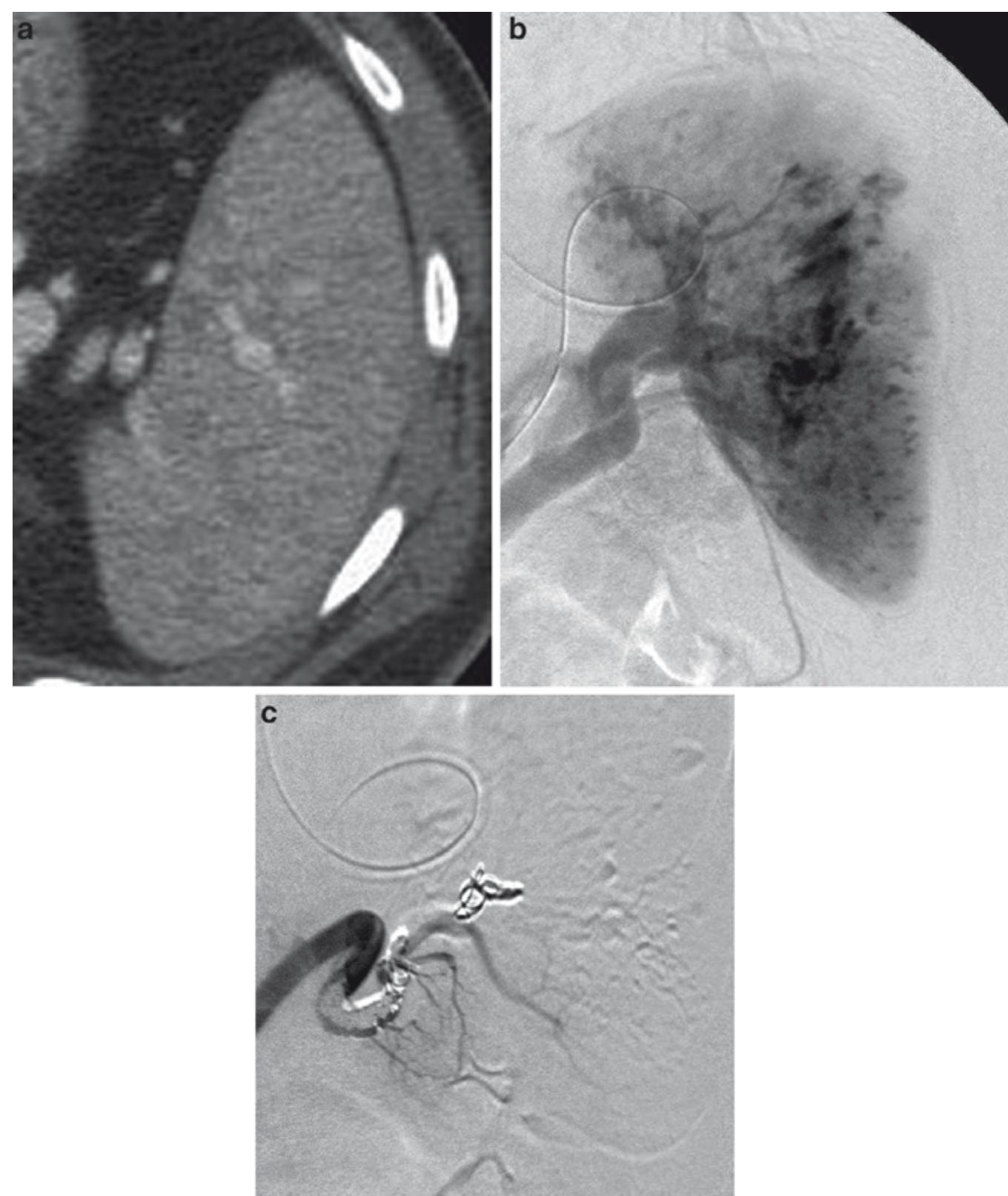 3. polytrauma to the abdomen: (a) ct scan demonstrates high