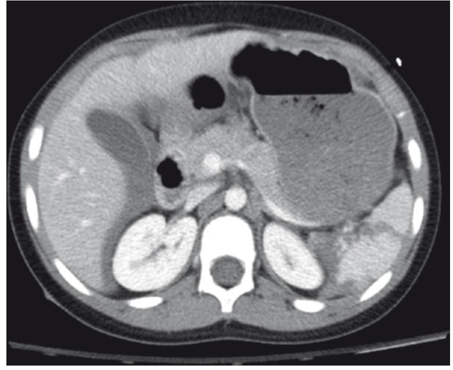 2 ct scan demonstrates a complex splenic laceration