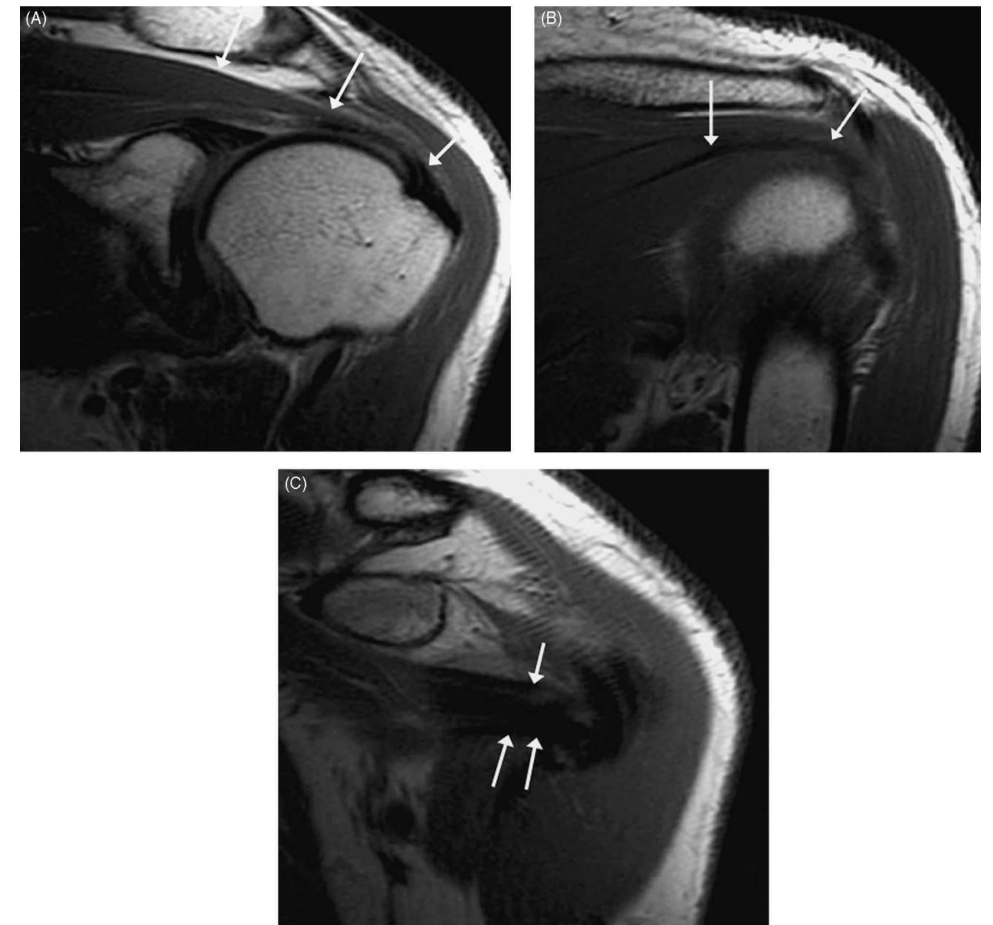 Anatomy of the rotator cuff. (a) coronal t2-weighted image