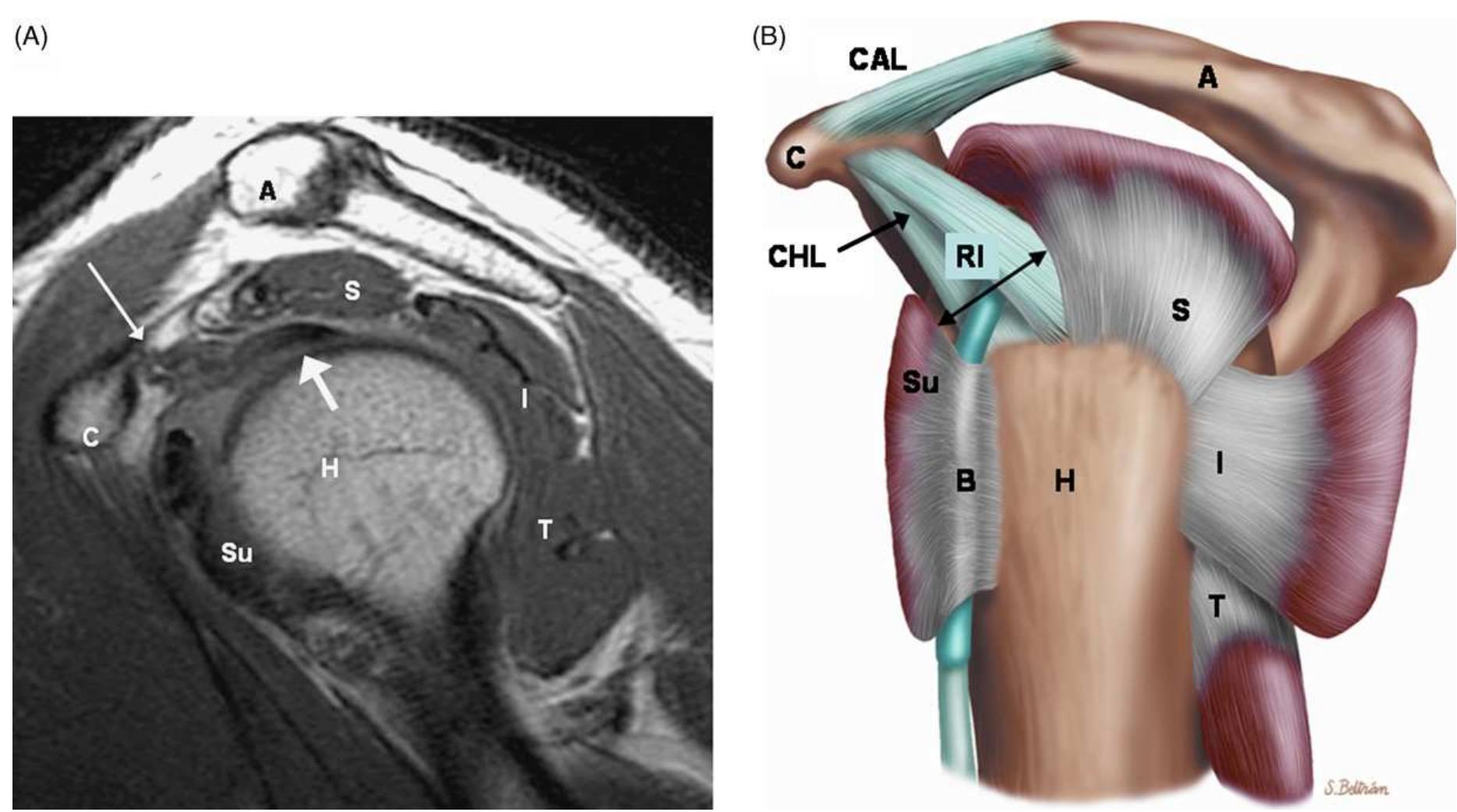 Coracoacromial arch and rotator cuff interval. (a) sagittal