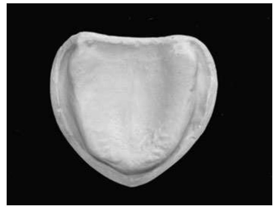 Edentulous maxillary cast.