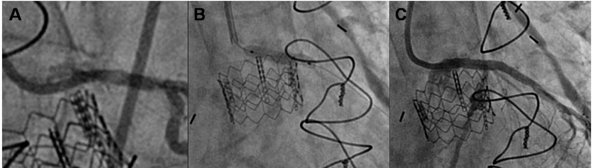 Left main stenting after transcatheter aortic valve