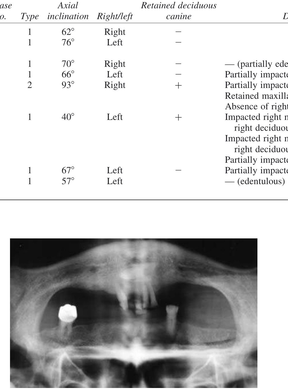 Patient 2 (mandibular). cropped panoramic radiograph showing