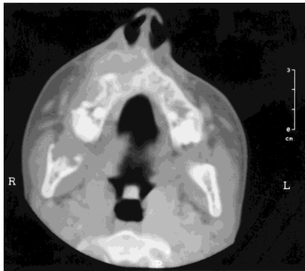 Proband’s axial ct scan: erosive bone lesions in the right