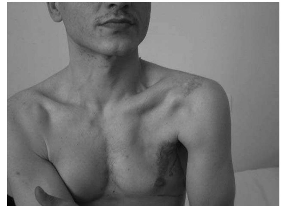 Preoperative photograph taken 2 years after injury. there