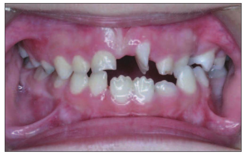 A: before treatment (frontal view) intraoral examination