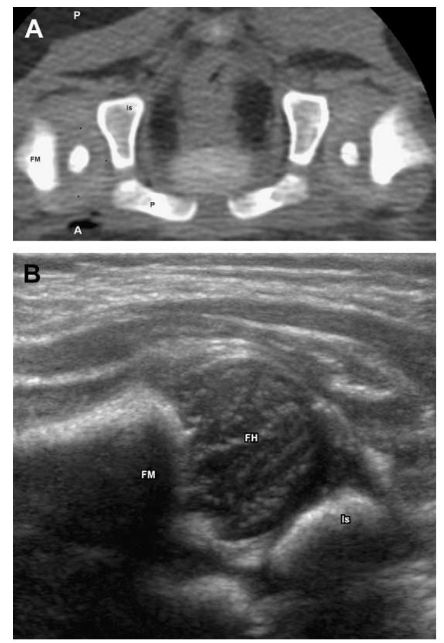 Normal transverse view. (a) axial ct image of the pelvis