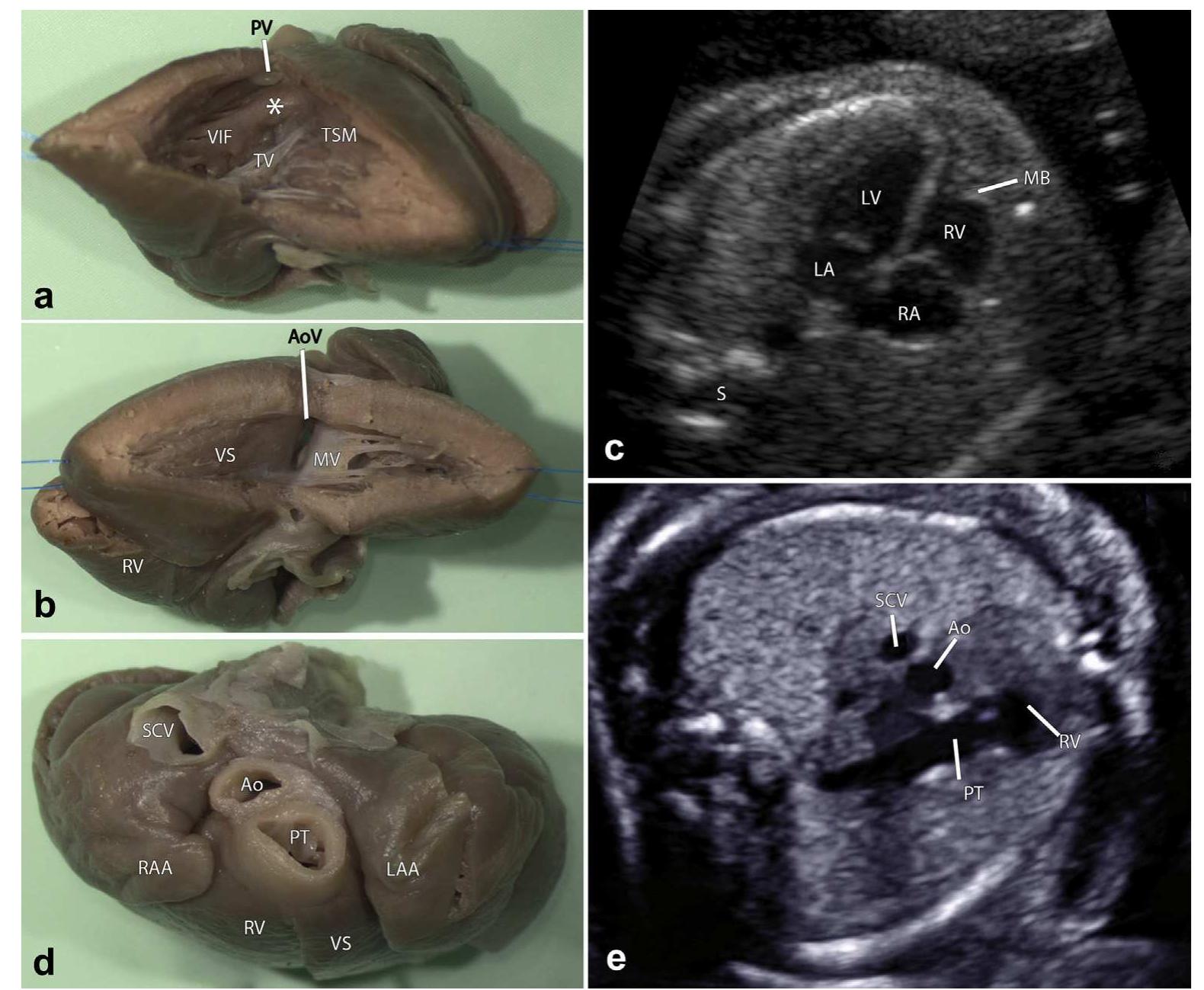 Normal fetal heart. (a) fetal heart (20 gestational weeks).