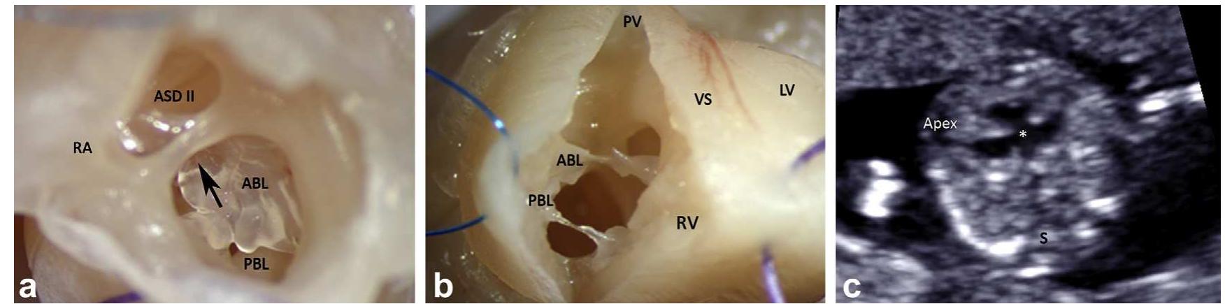 Atrioventricular septal defect. (a) fetal heart (14