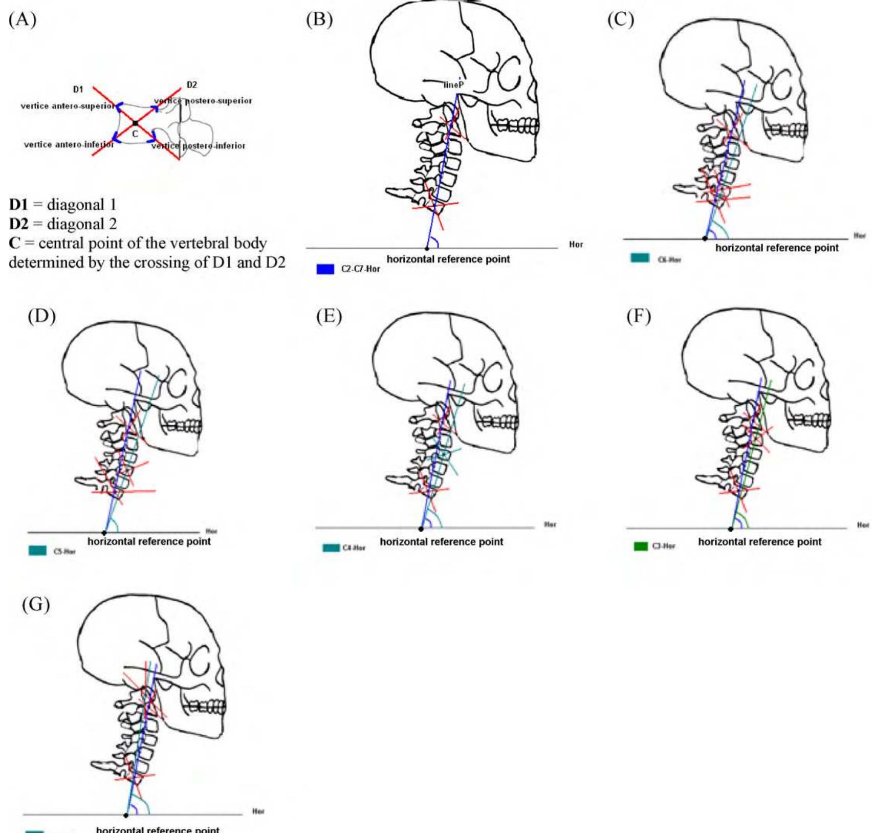 Tracings of the cervical spine angles. (a) tracing of the