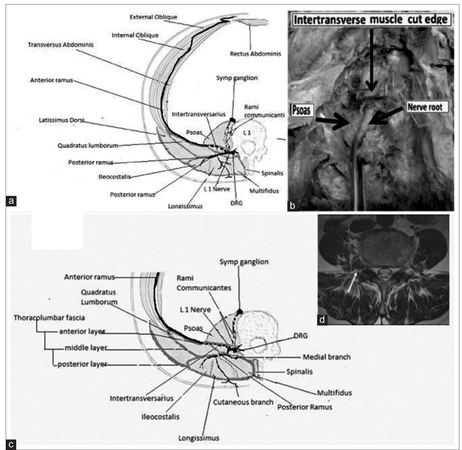 Figure 4 - from A new perspective of neuromyopathy to