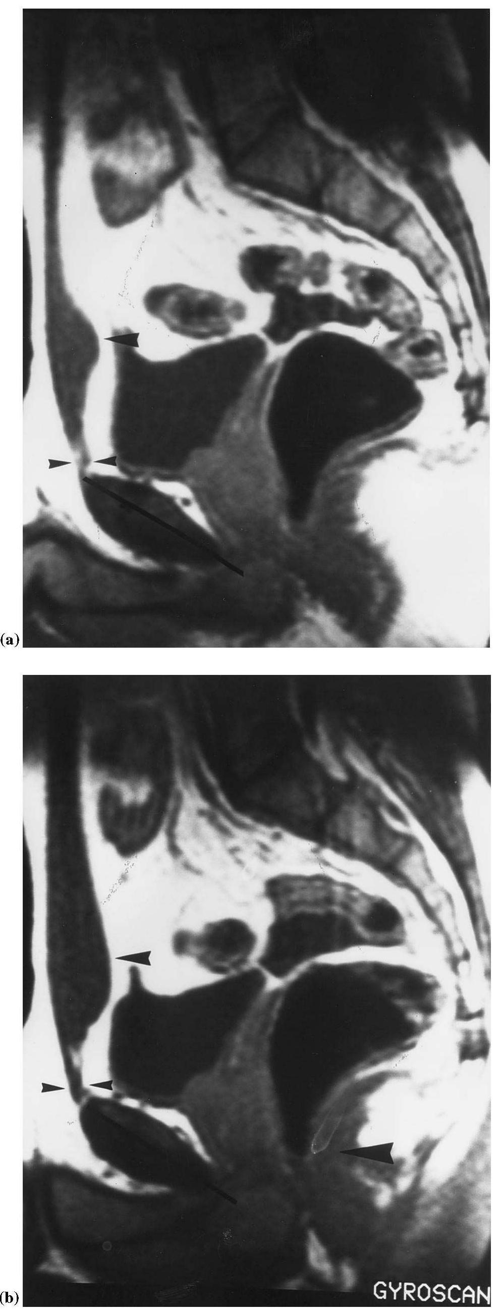 (a, b) groin pain: sagittal tl-weighted se mri shows