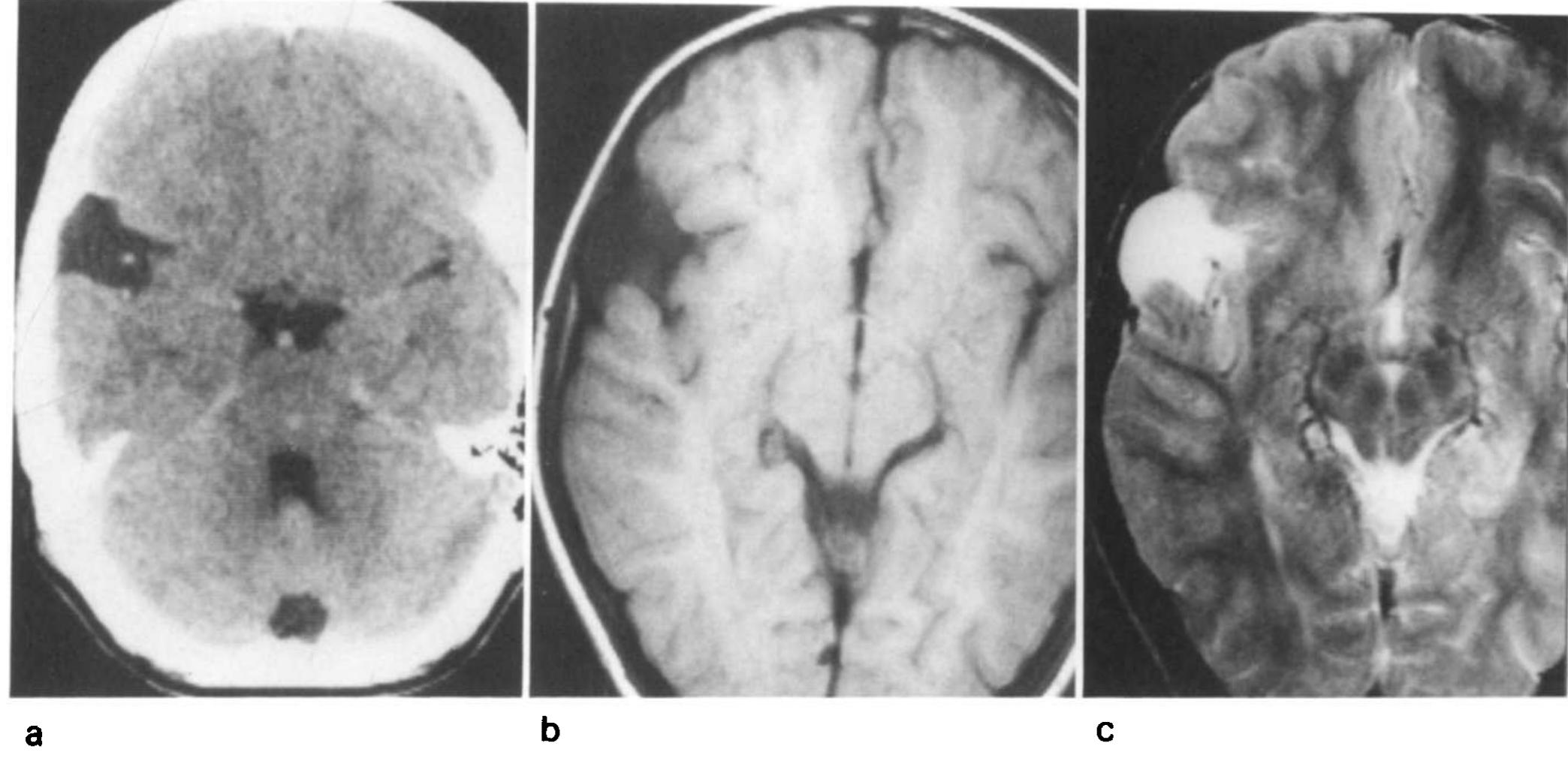 (a) ct-scan of an arachnoid cyst in a 12-year-old boy with