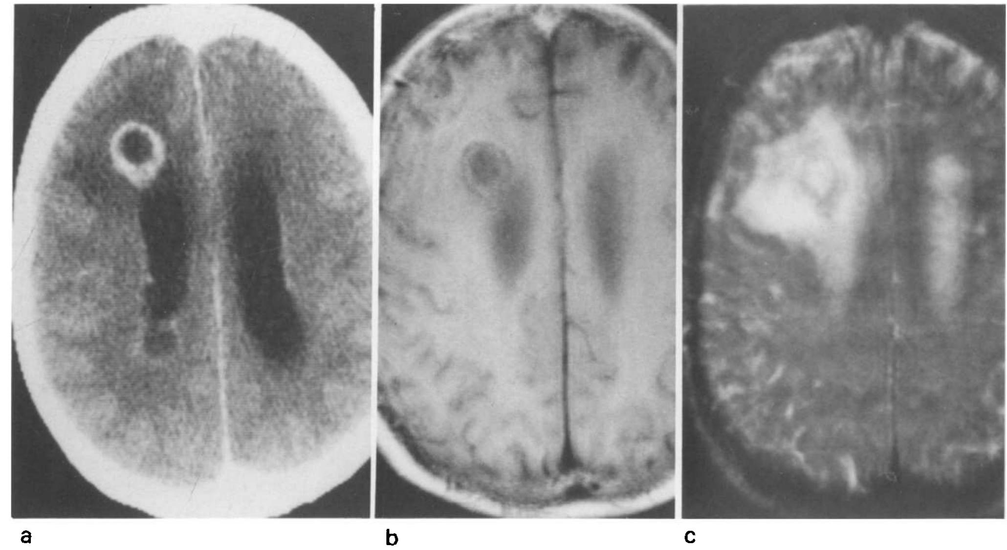 (a) ct-scan of a frontal abscess in a 62 year old male