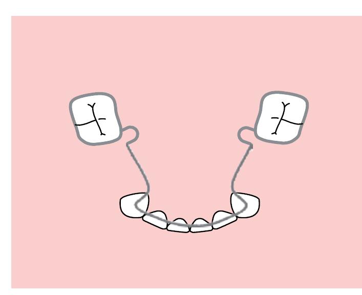 Lingual arch space maintainer with u-loops figure 7. lingual