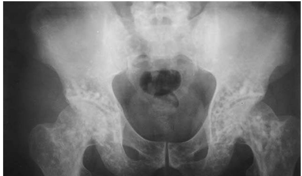 Anterior-posterior pelvis x-ray revealed multiple circular