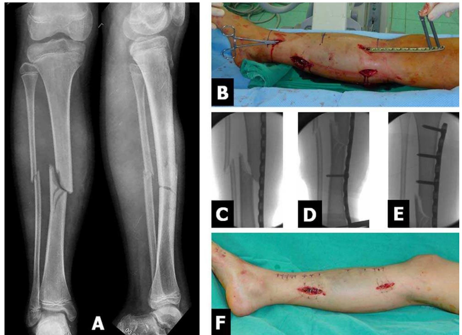 (case no. 8) (a) radiograph showing a tibial diaphyseal
