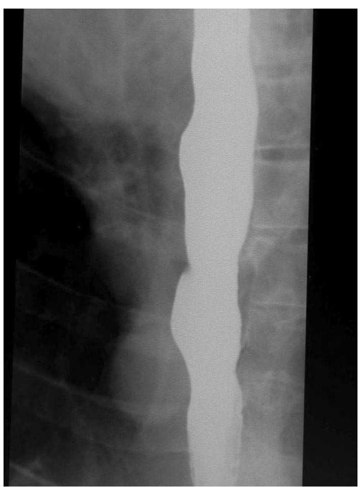 Postoperative barium swallow. ing pectoralis major