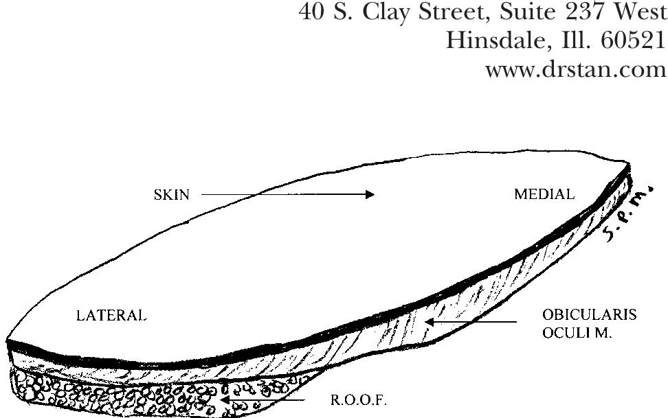 Illustration of the composite resection in the upper eyelid