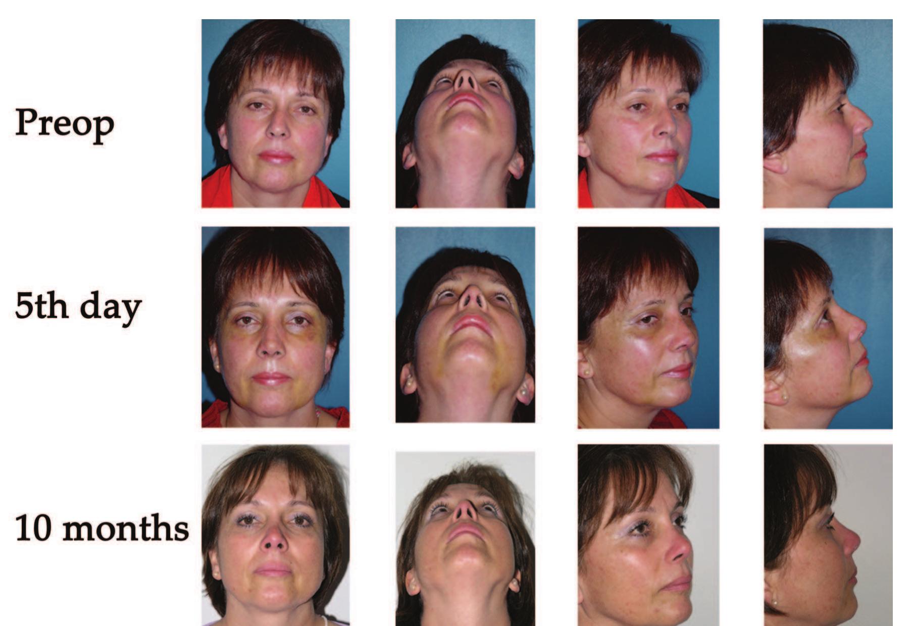 (above) preoperative views of a 43-year-old woman with a