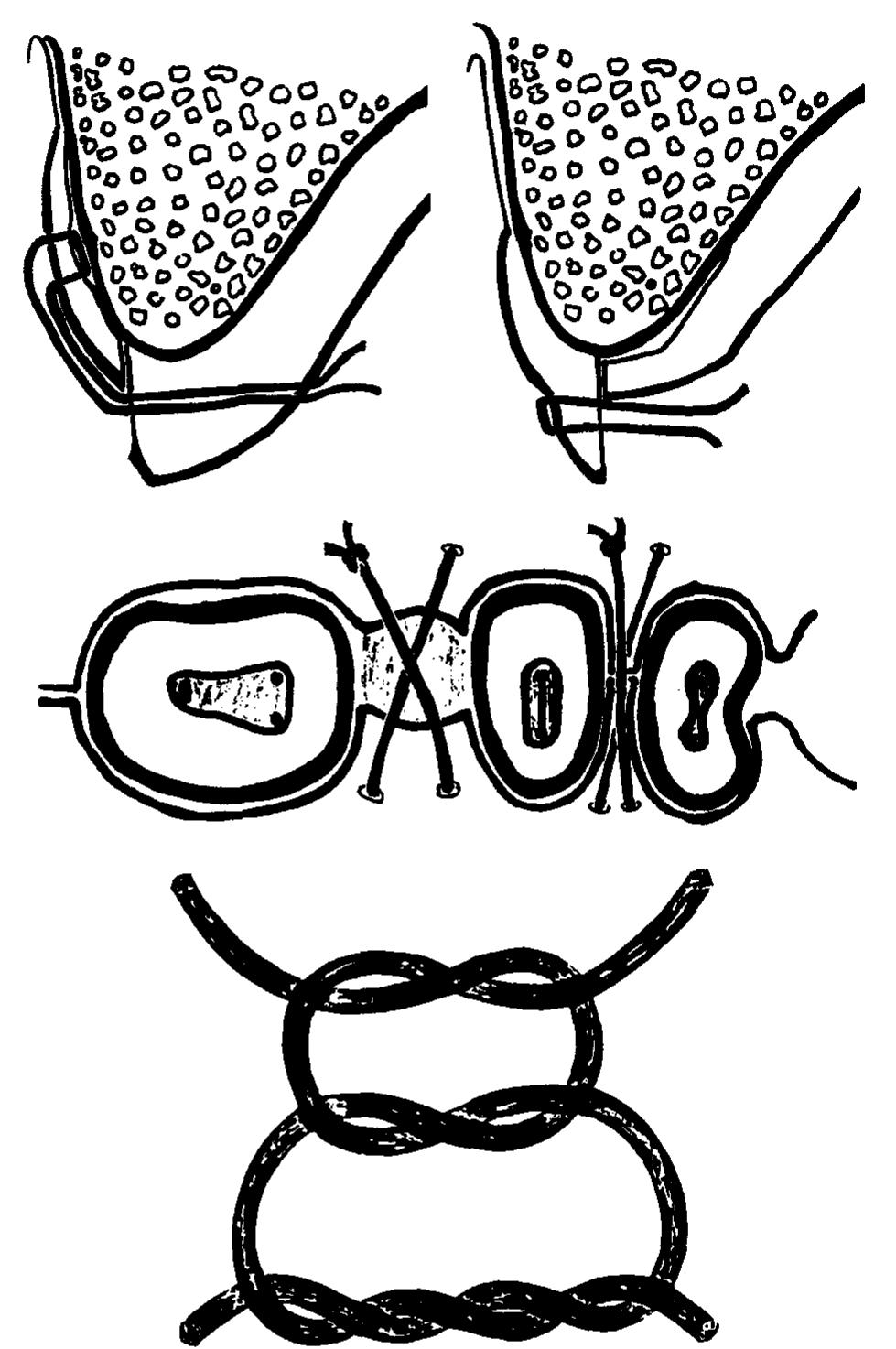 Top. the left figure demonstrates a vertical mattress used