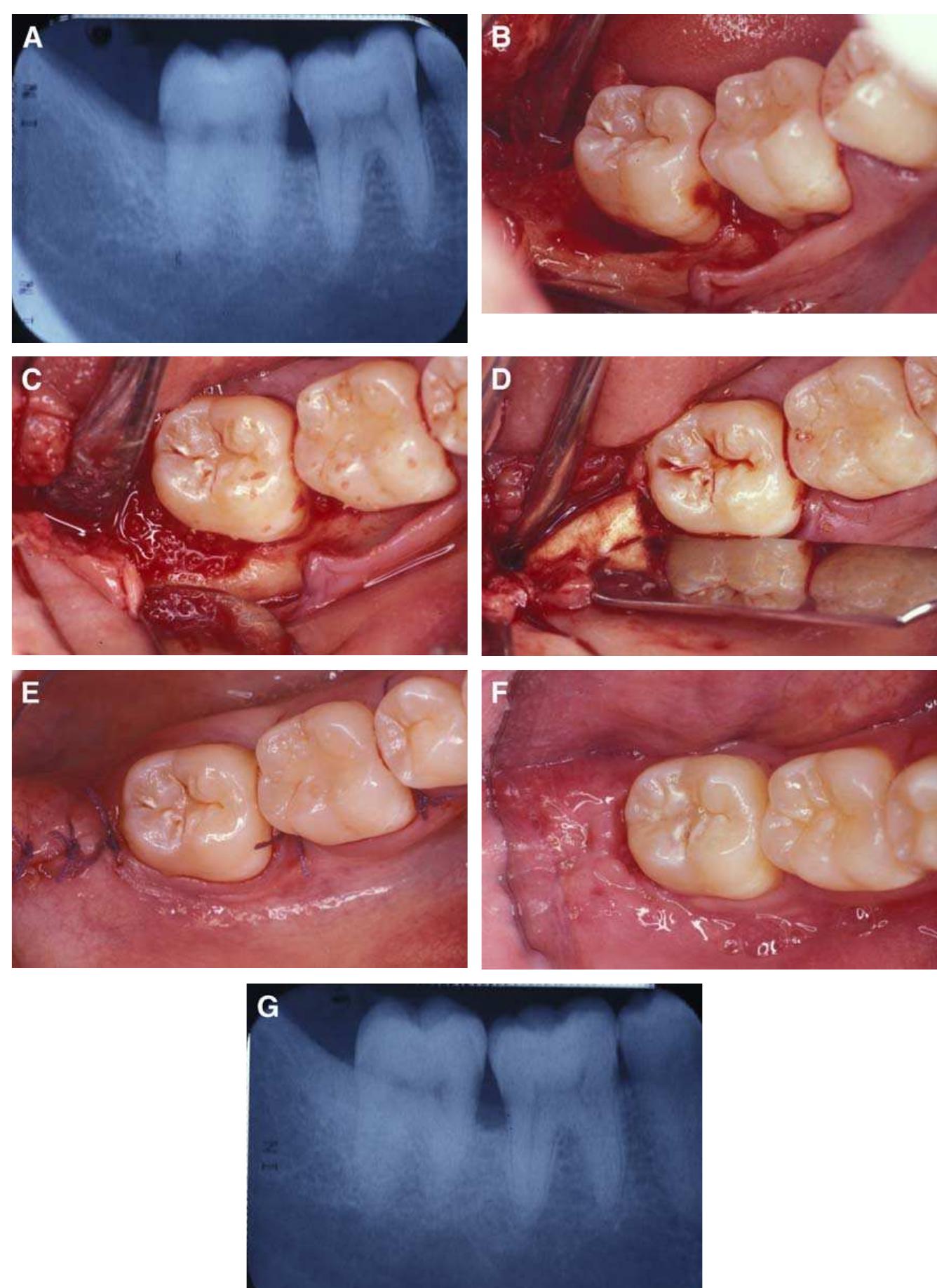 (a) preoperative radiograph showing the infrabony defect on