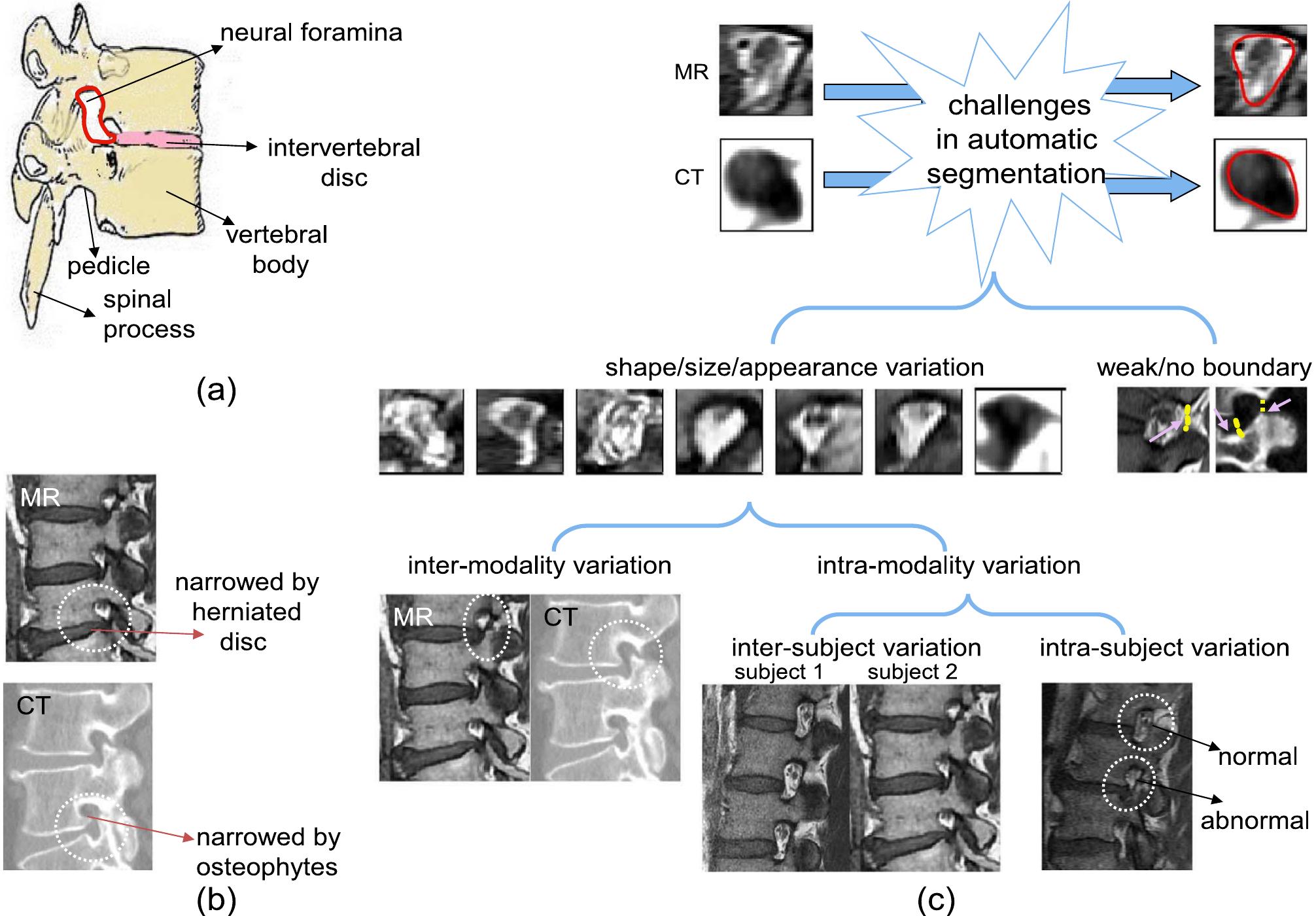 (a) the anatomy of neural foramina; (b) two common