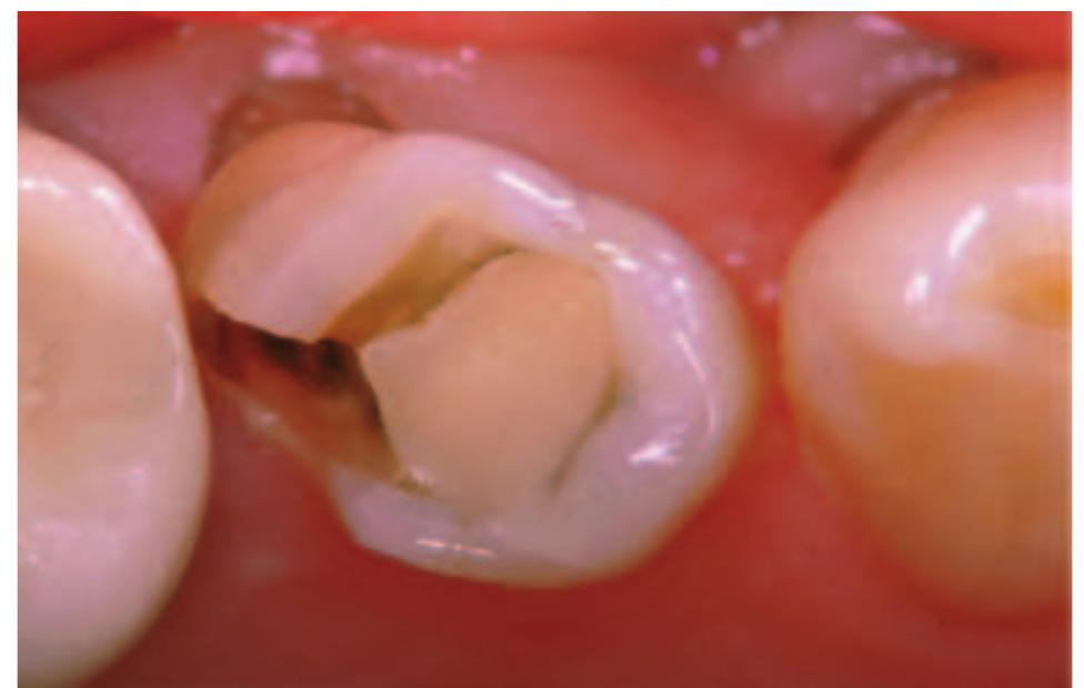 Occlusal view of maxillary bicuspid with tooth fracture and