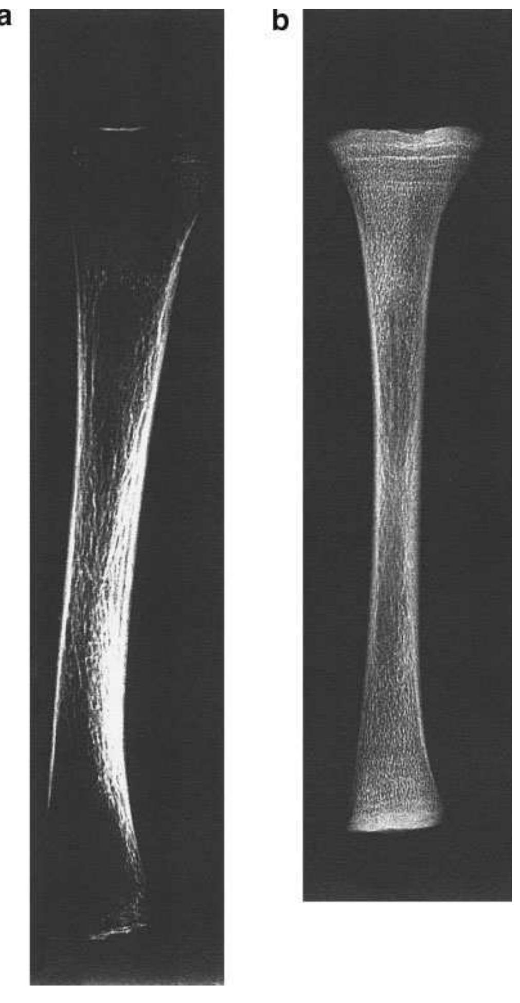 A: anterio-posterior radiograph, tibia burial hb402. note