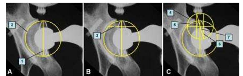 Figure 3 - Measurement of acetabular cup anteversion with
